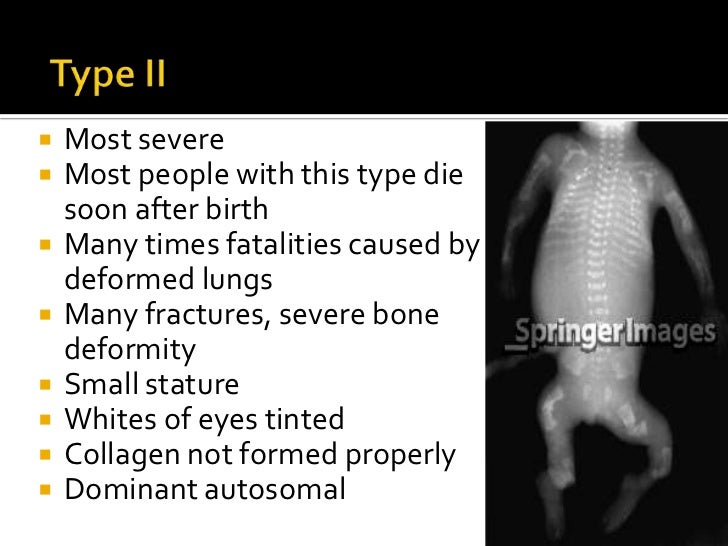 Types And Types Of Osteogenesis Imperfecta