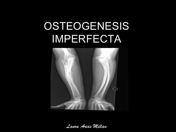 osteogenesis imperfecta