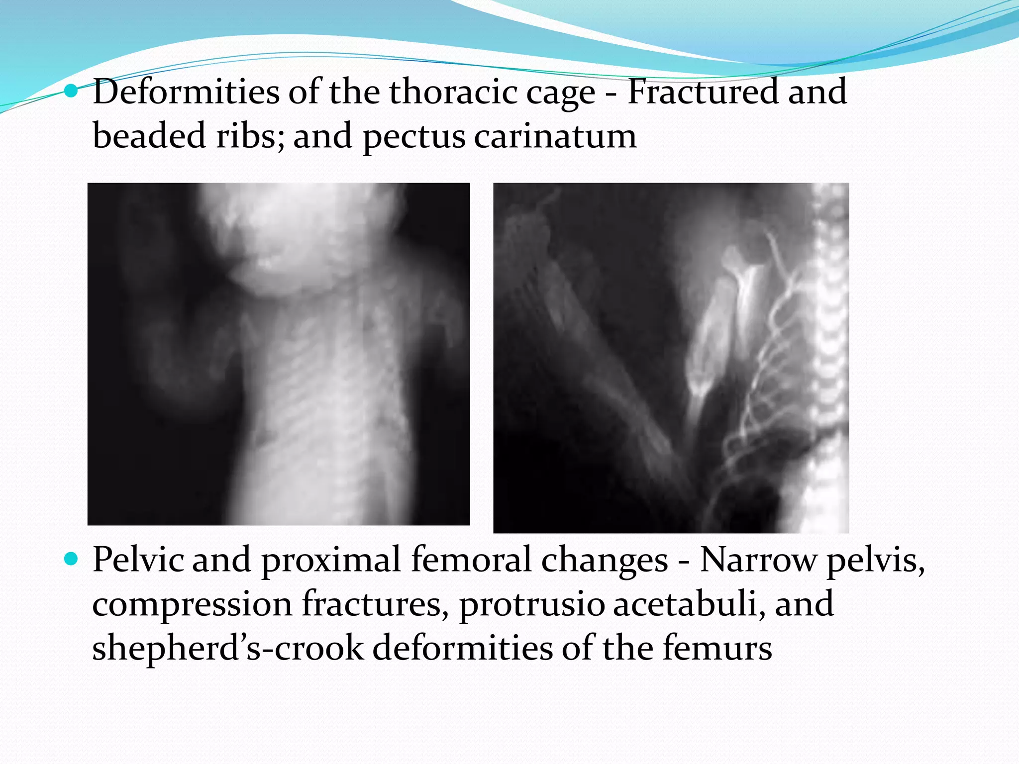 Osteogenesis imperfecta | PPTX