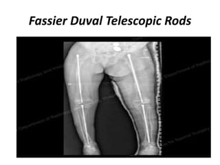 Osteogenesis imperfecta | PPTX