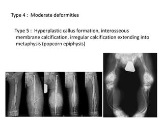 Osteogenesis imperfecta | PPTX