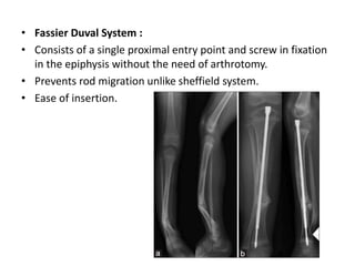 Osteogenesis imperfecta | PPTX
