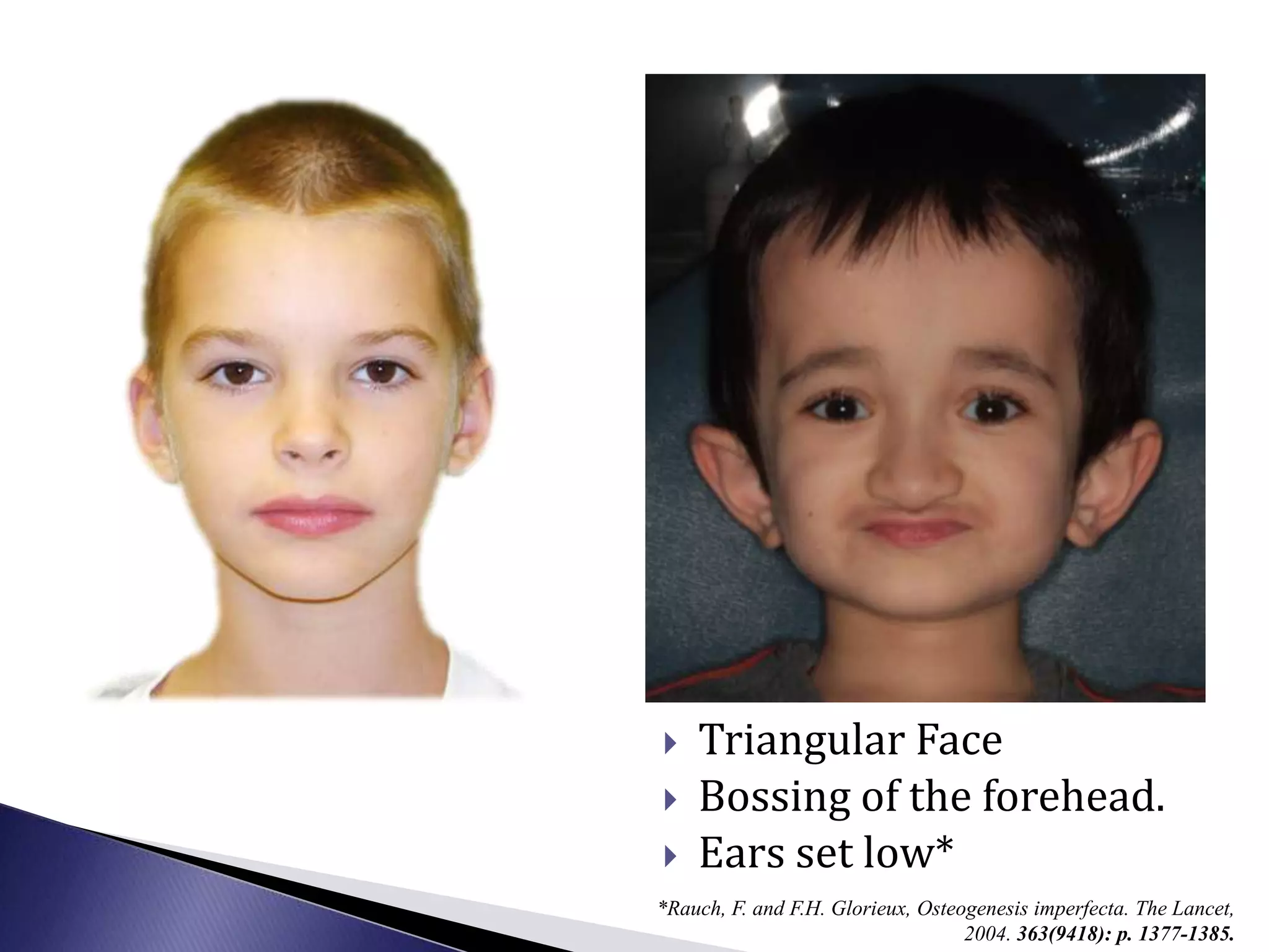 Dental management of Osteogenesis imperfecta.slideshare | PPTX