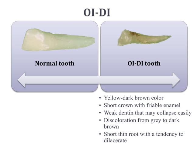 Dental management of Osteogenesis imperfecta.slideshare | PPT