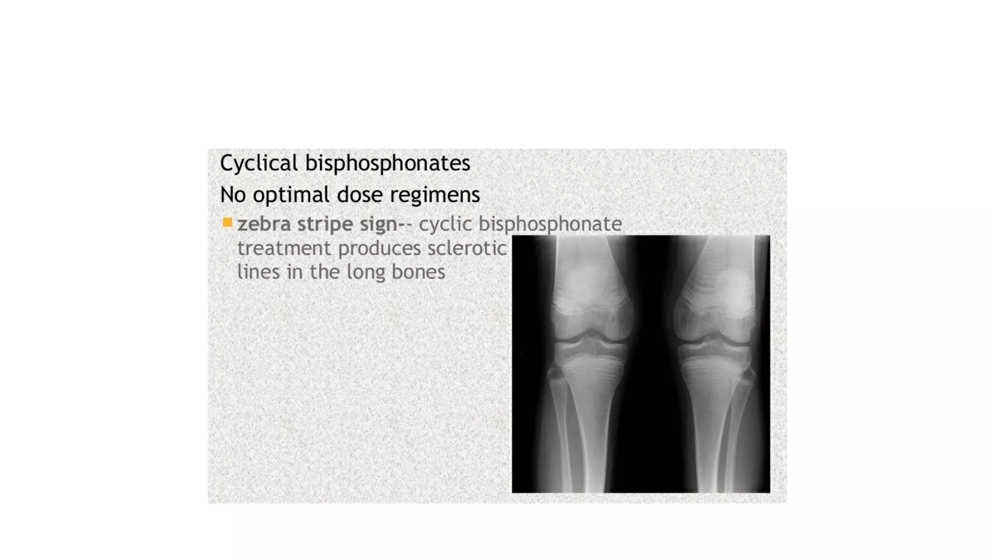 Osteogenesis imperfecta by Dr Aniket | PPTX