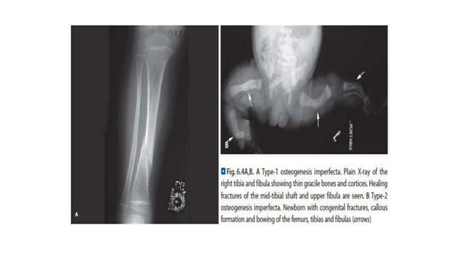 Osteogenesis imperfecta by Dr Aniket | PPTX