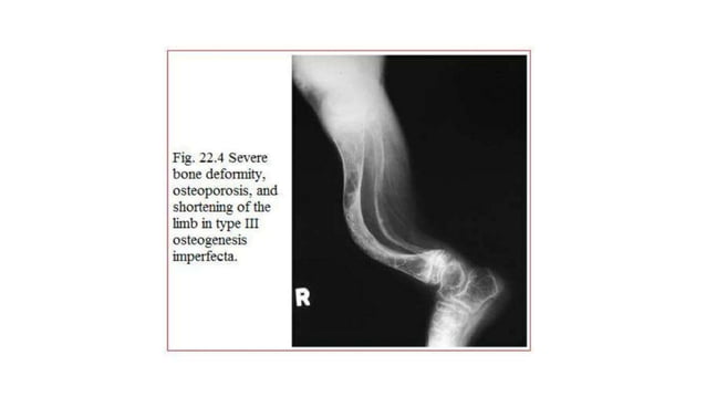 Osteogenesis imperfecta by Dr Aniket | PPTX