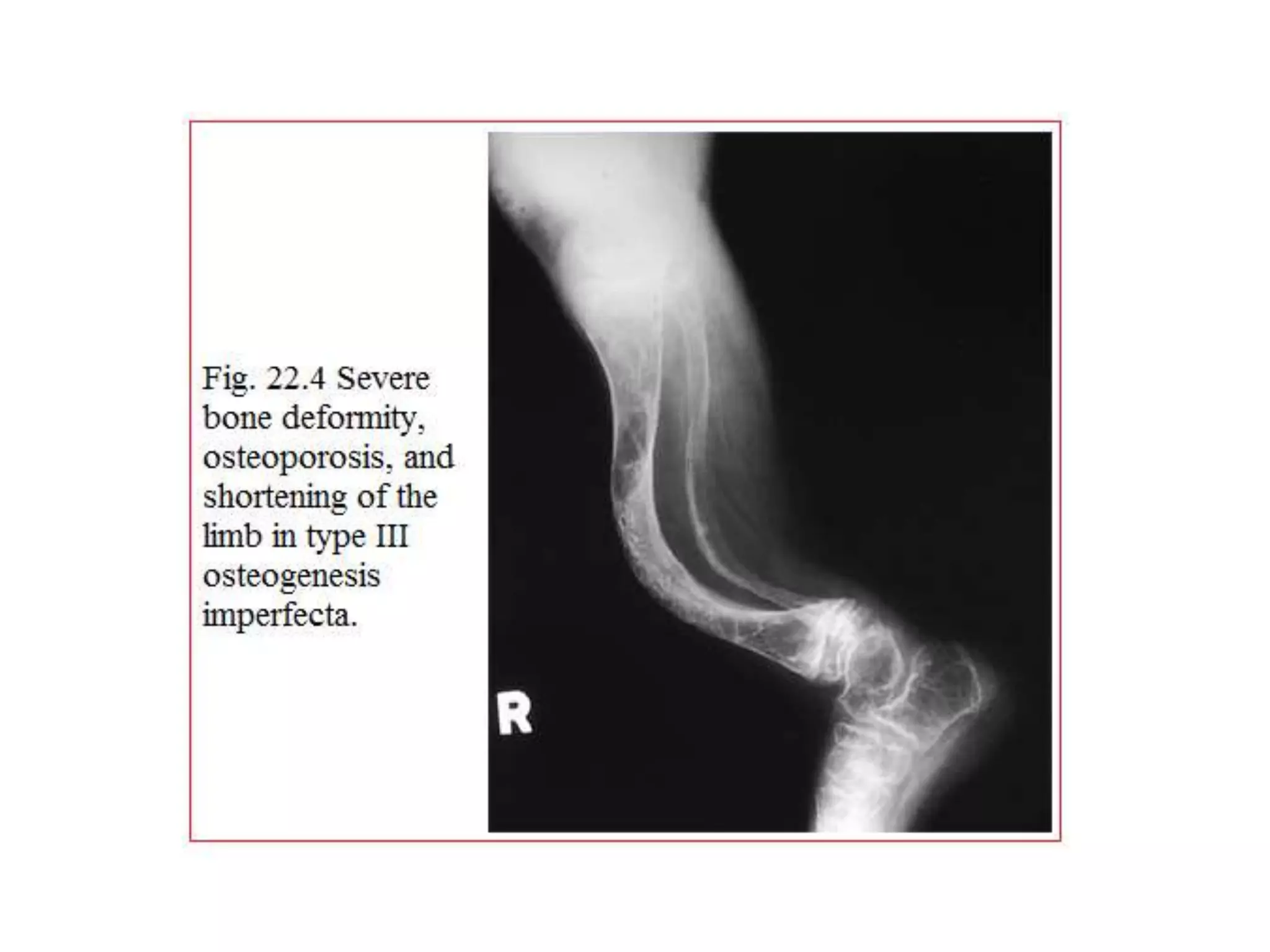 Osteogenesis imperfecta (dr. mahesh) | PPTX