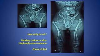 Osteogenesis imperfecta mumbai | PPTX