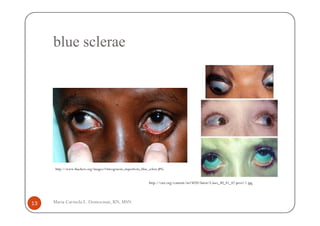 Blue Sclerae: Diagnosis At A Glance – IXXLIQ