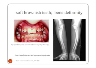 Osteogenesis imperfecta (OI) | PDF