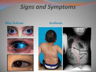 Osteogenesis Imperfecta Symptoms