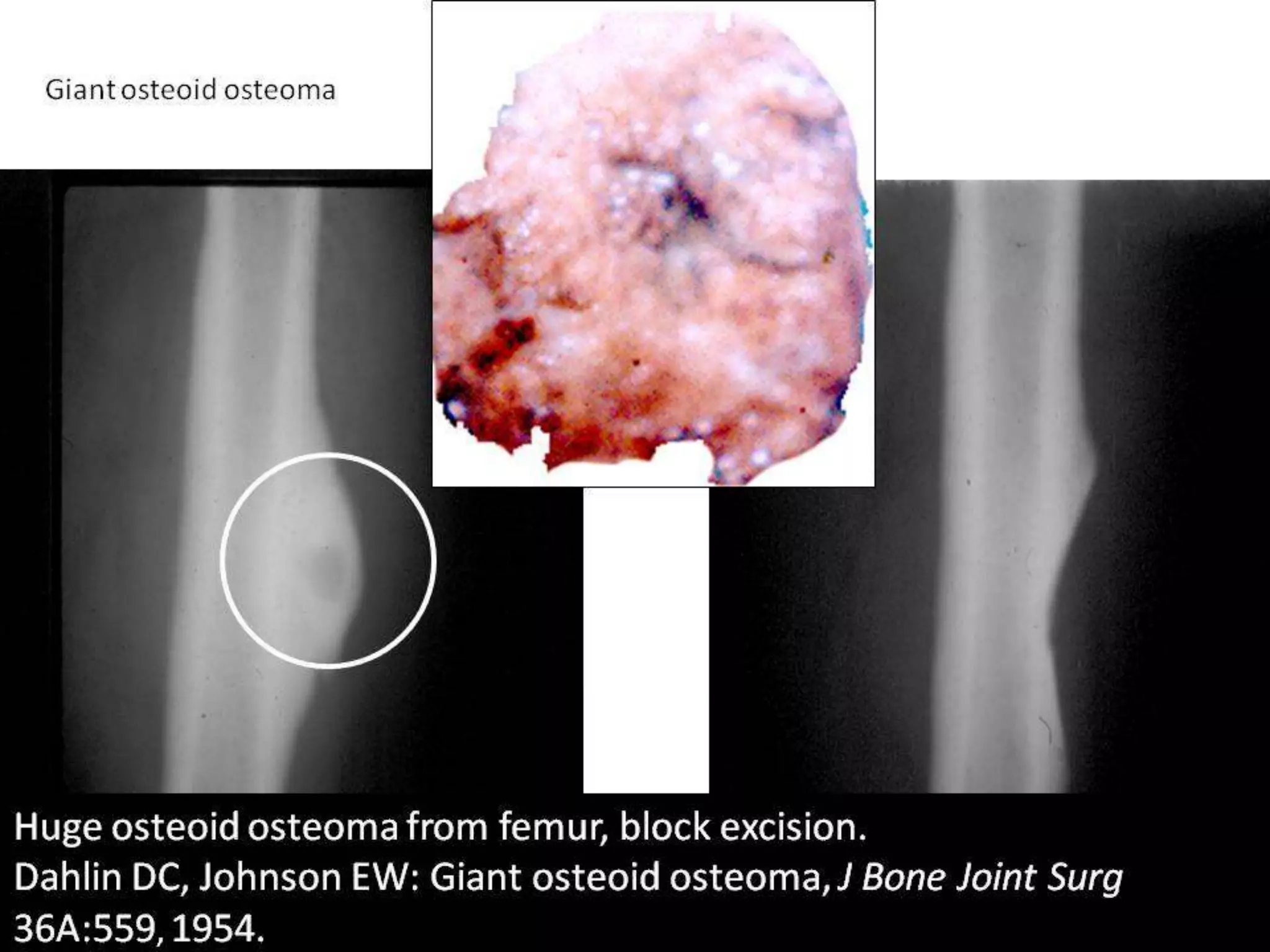 Osteoid osteoma | PPTX