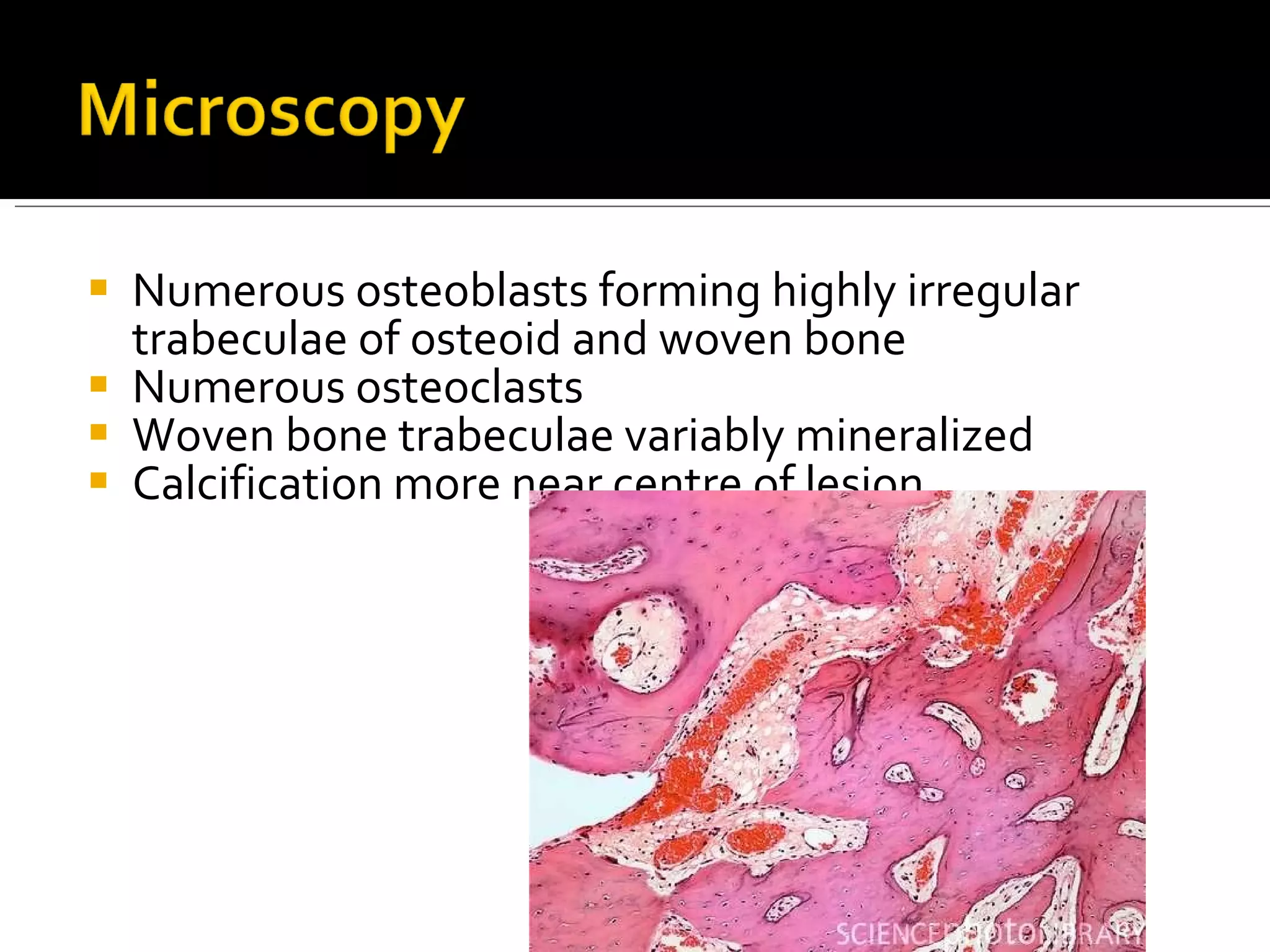 Osteoid+Osteoma | PPT