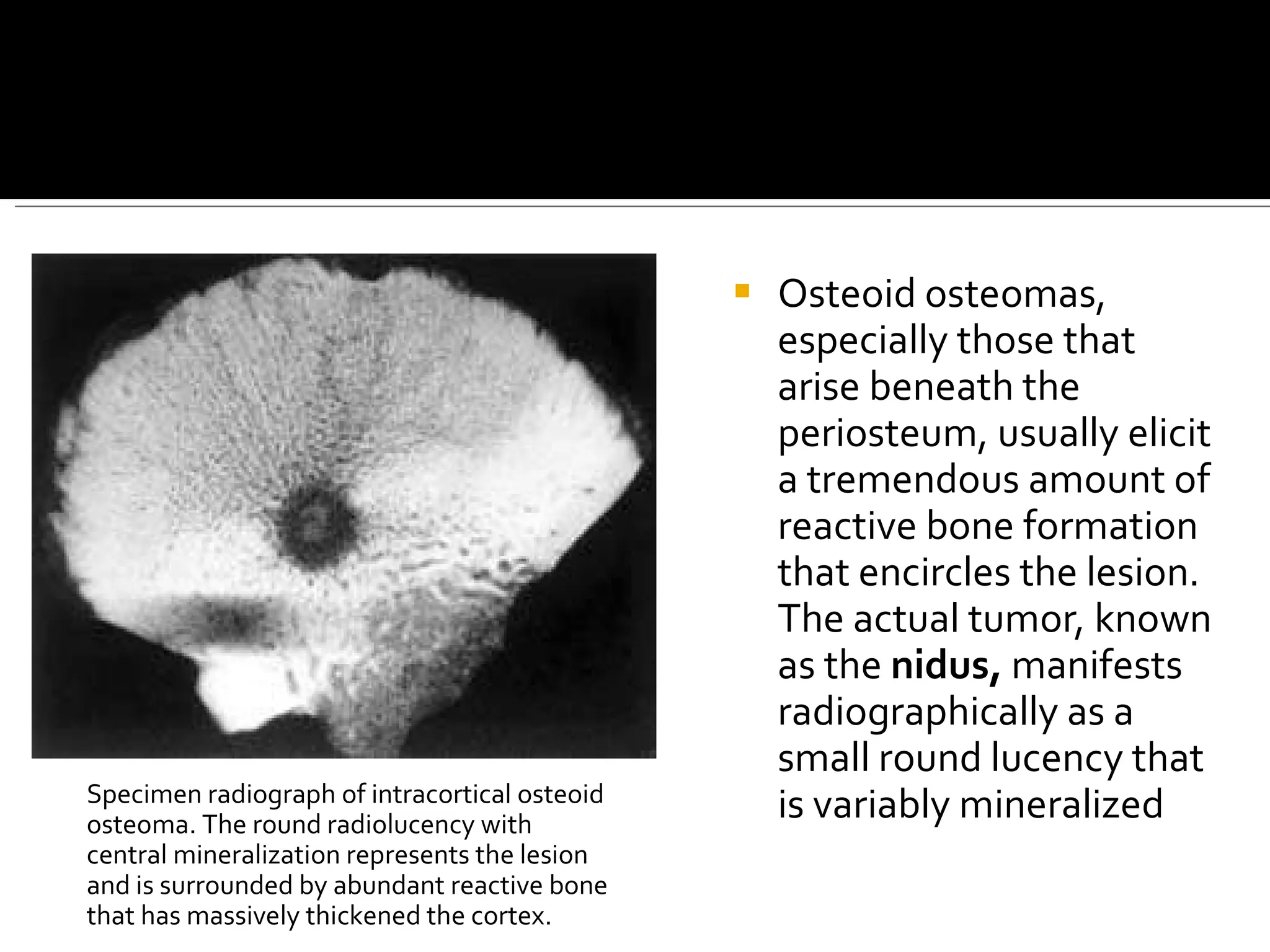 Osteoid+Osteoma | PPT