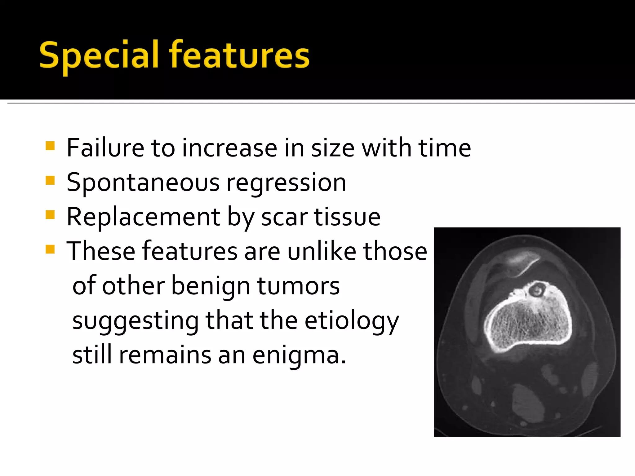 Osteoid+Osteoma | PPT