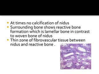 Osteoid+Osteoma | PPT