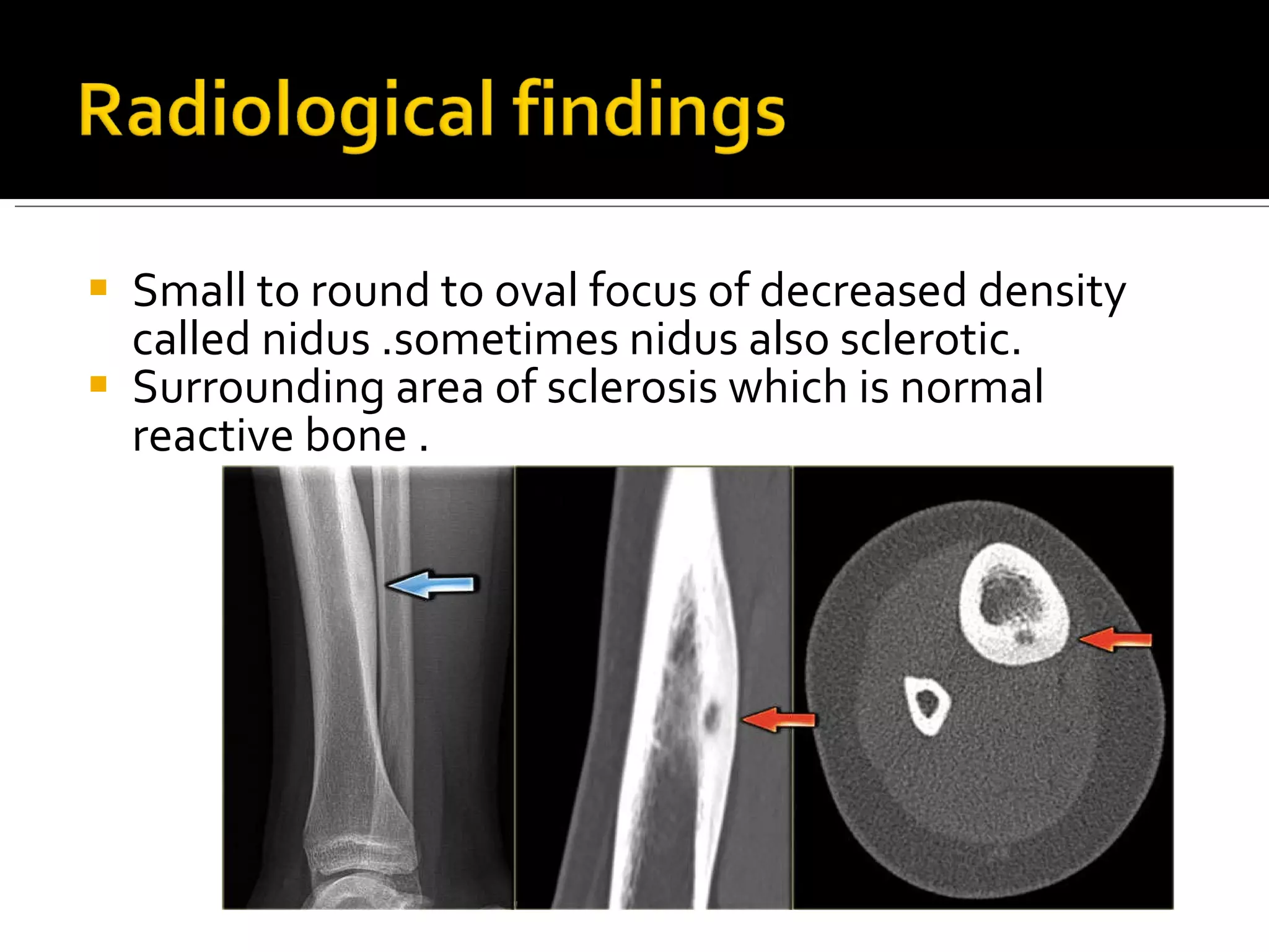 Osteoid+Osteoma | PPT