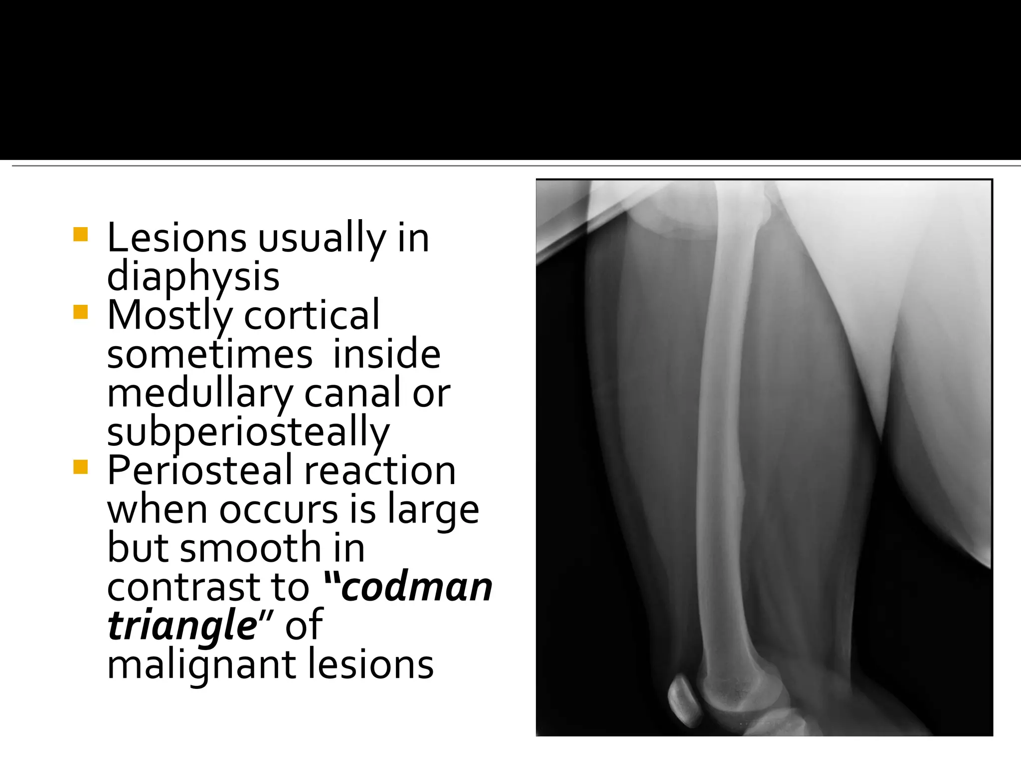 Osteoid+Osteoma | PPT