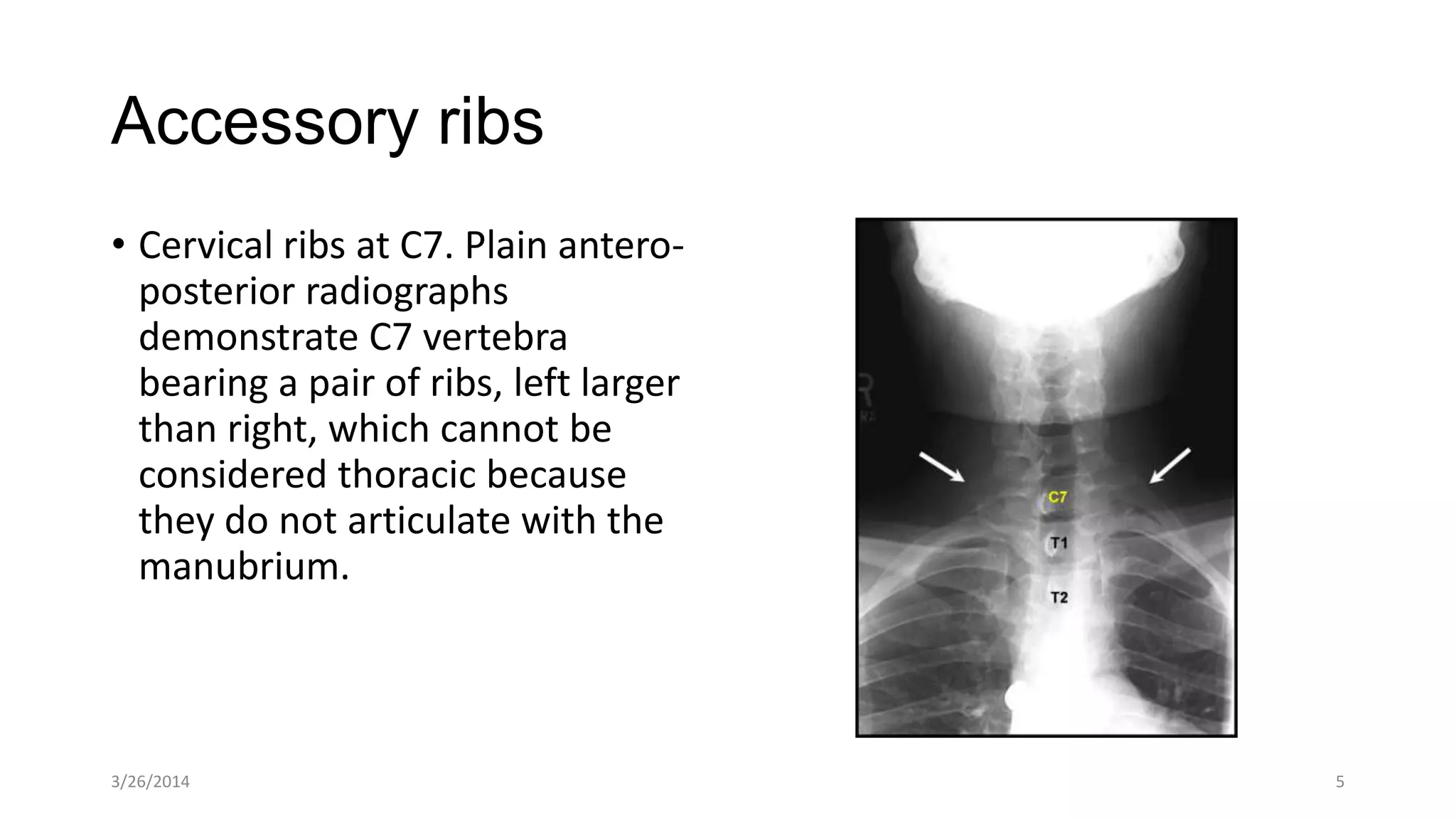 Osteology of thoracic cage | PPTX