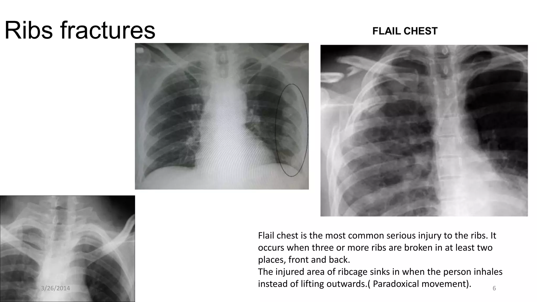 Osteology of thoracic cage | PPTX