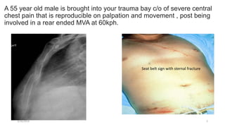 Osteology of thoracic cage | PPTX