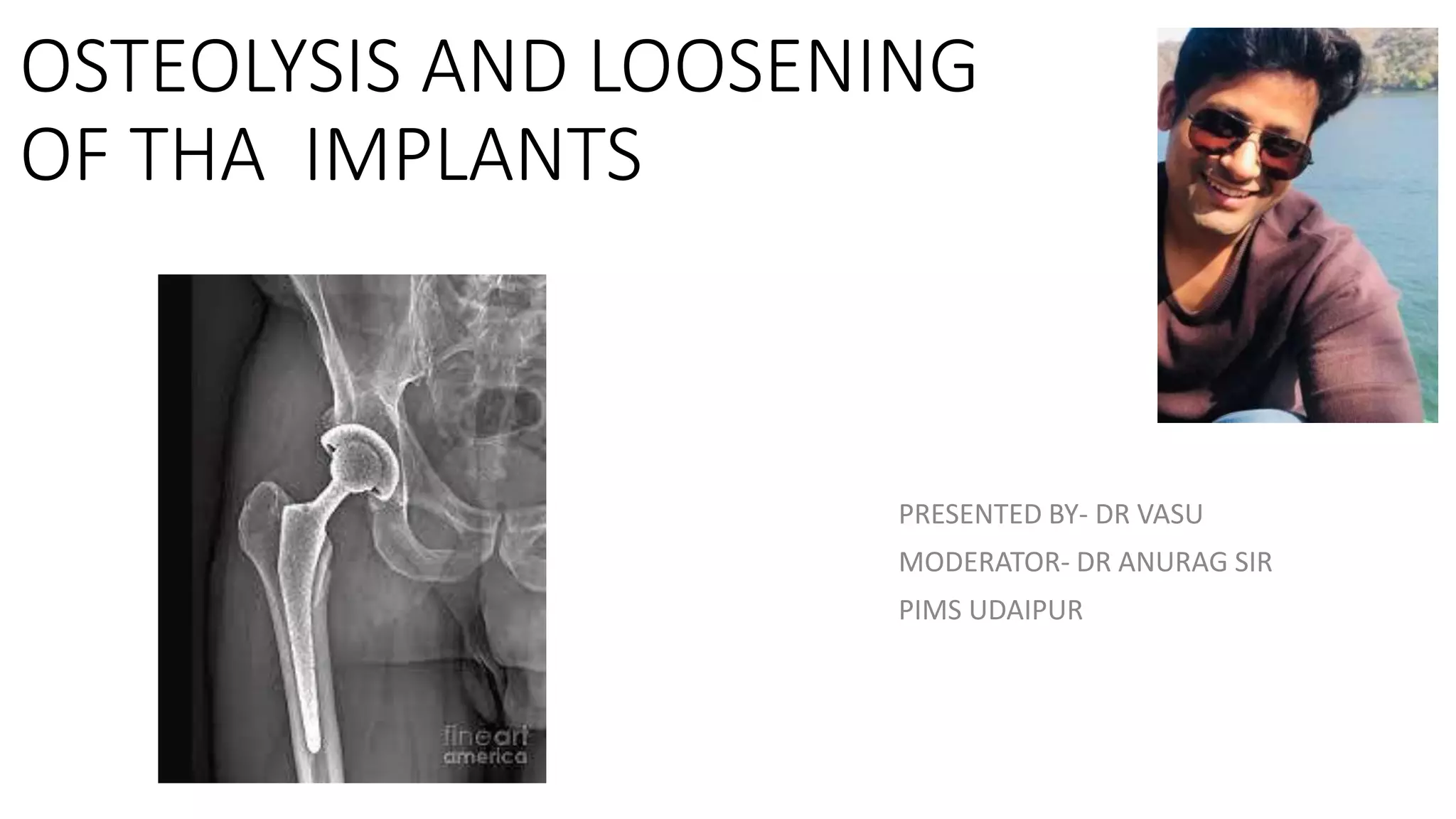 OSTEOLYSIS AND LOOSENING OF total hip arthroplasty IMPLANTS.pptx by dr ...