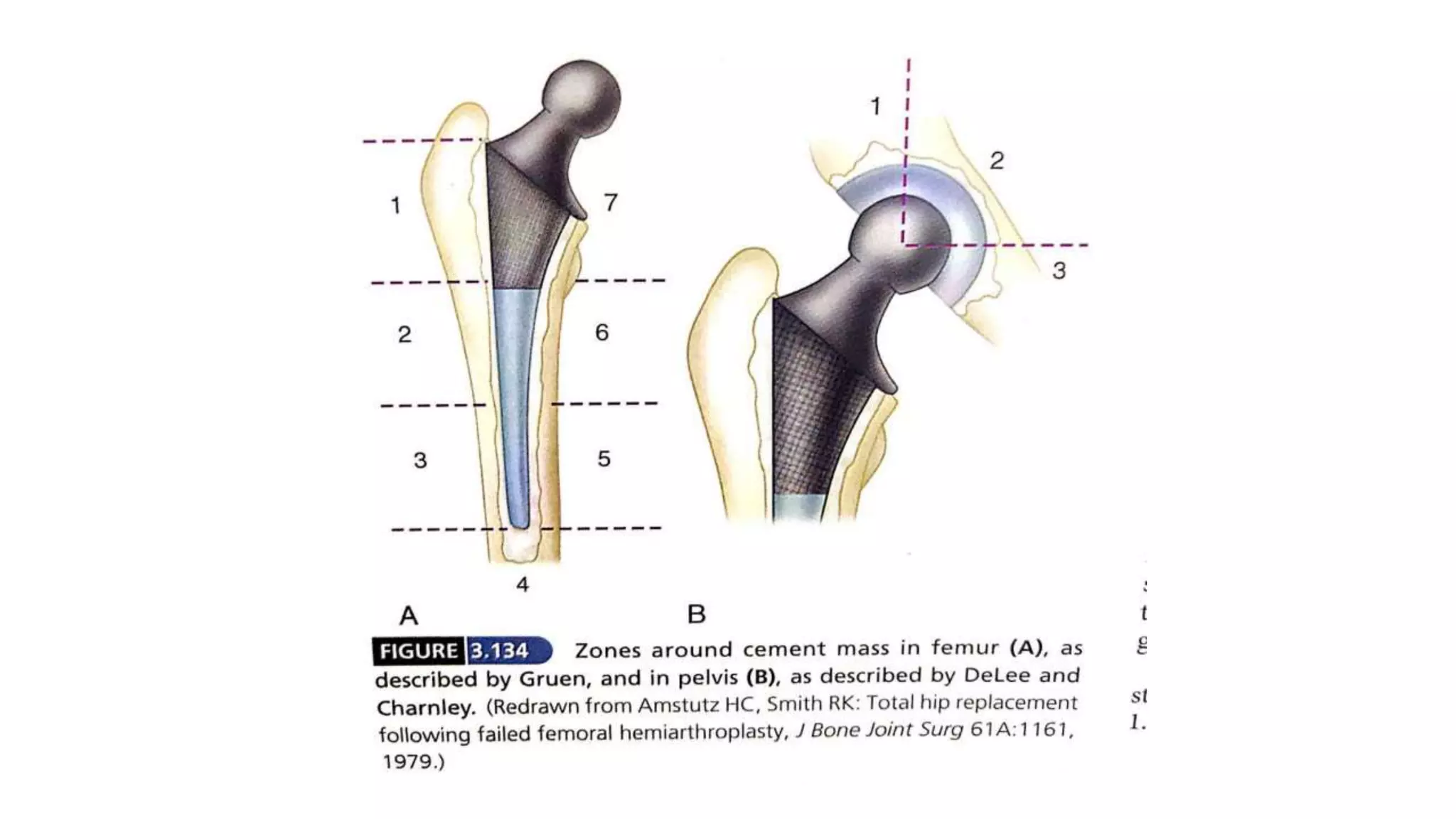 OSTEOLYSIS AND LOOSENING OF total hip arthroplasty IMPLANTS.pptx by dr ...