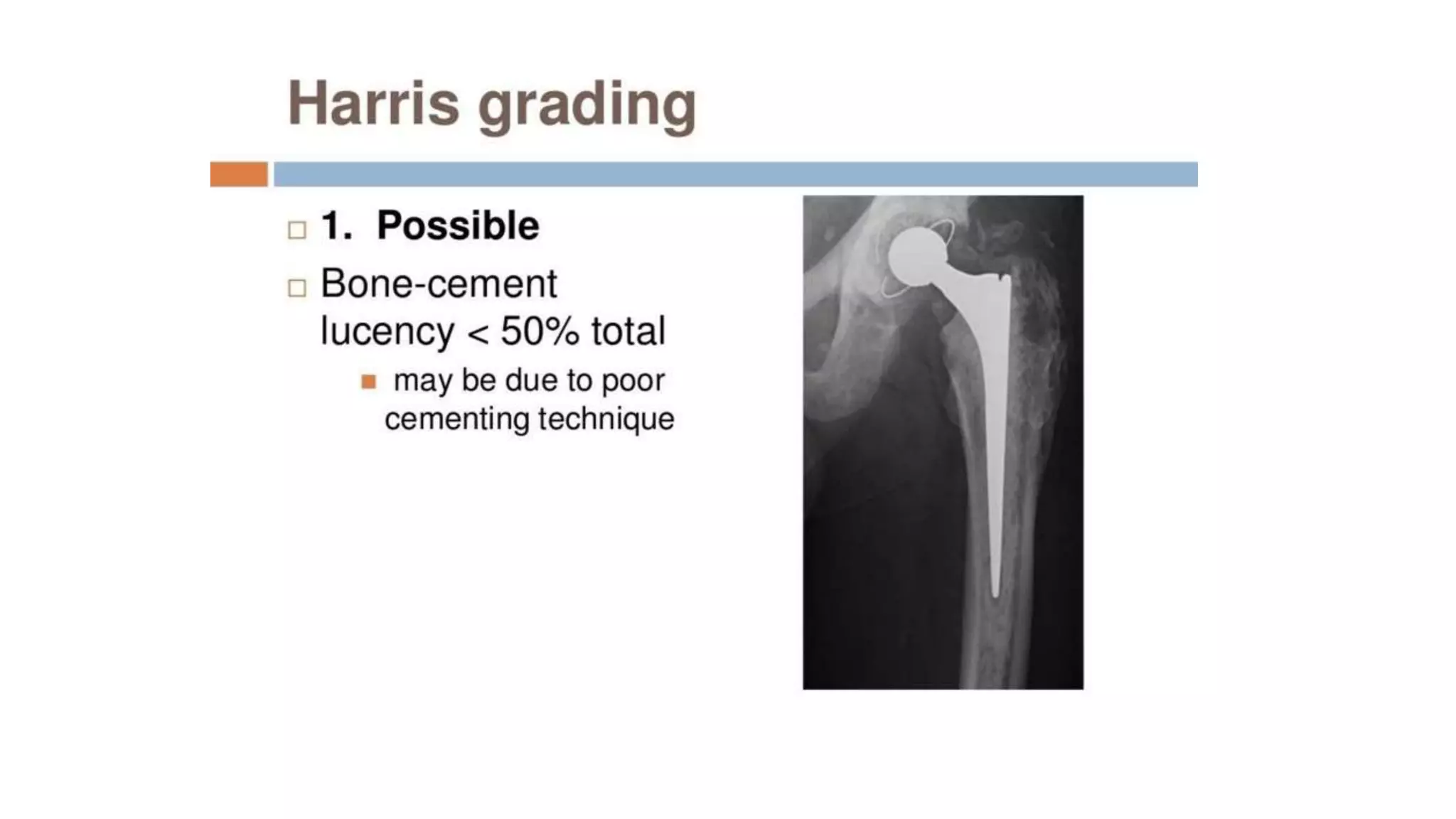 OSTEOLYSIS AND LOOSENING OF total hip arthroplasty IMPLANTS.pptx by dr ...