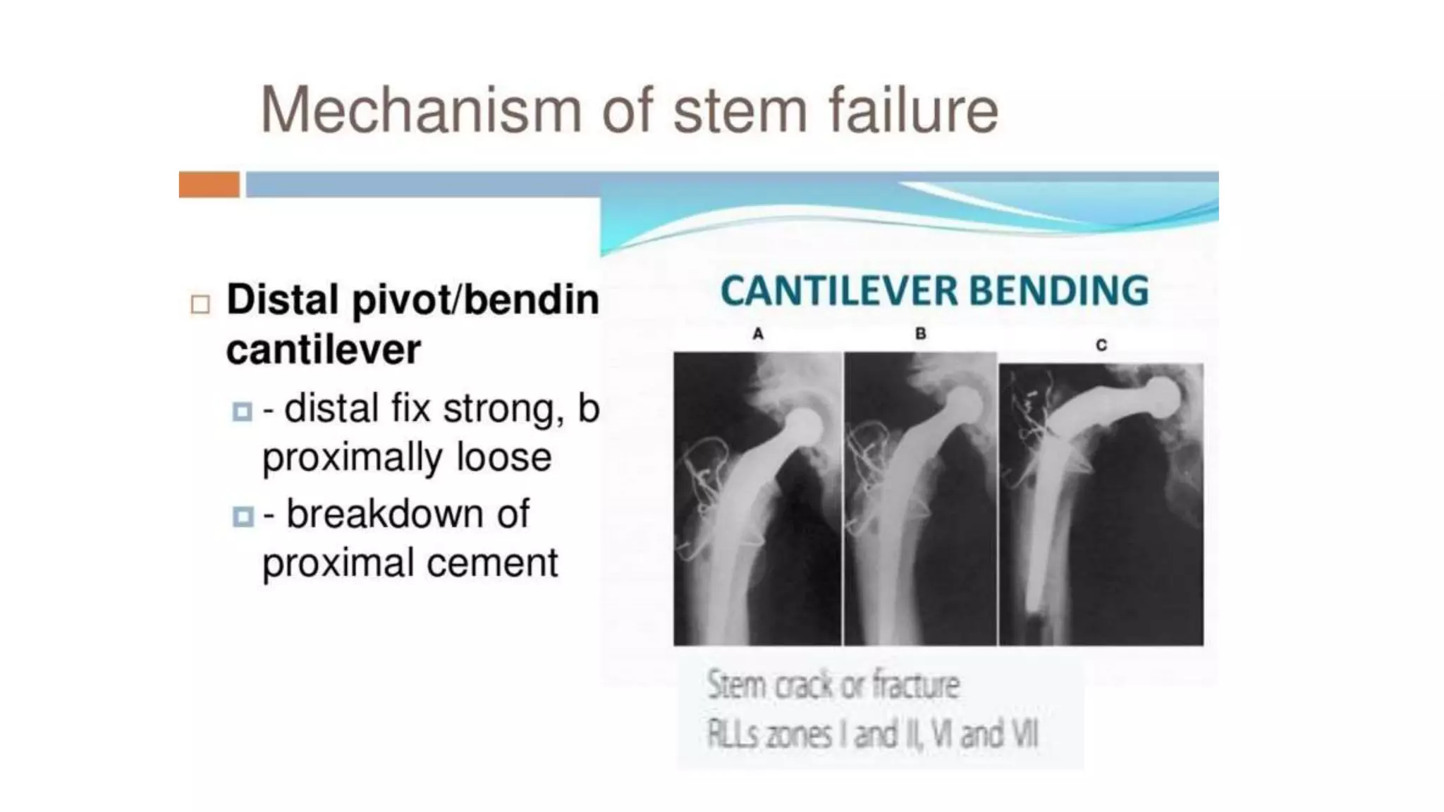 OSTEOLYSIS AND LOOSENING OF total hip arthroplasty IMPLANTS.pptx by dr ...