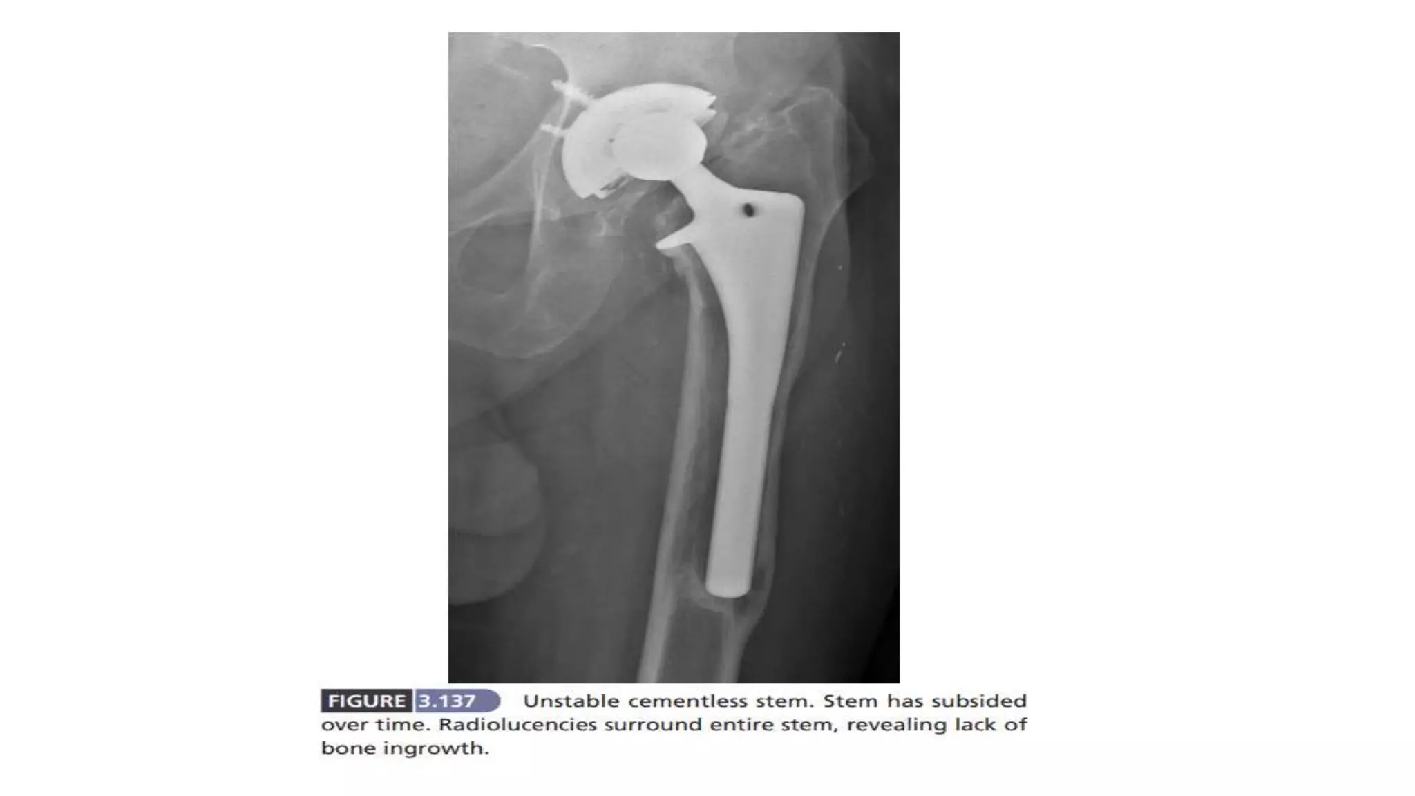 OSTEOLYSIS AND LOOSENING OF total hip arthroplasty IMPLANTS.pptx by dr ...