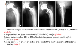 OSTEOLYSIS AND LOOSENING OF total hip arthroplasty IMPLANTS.pptx by dr ...