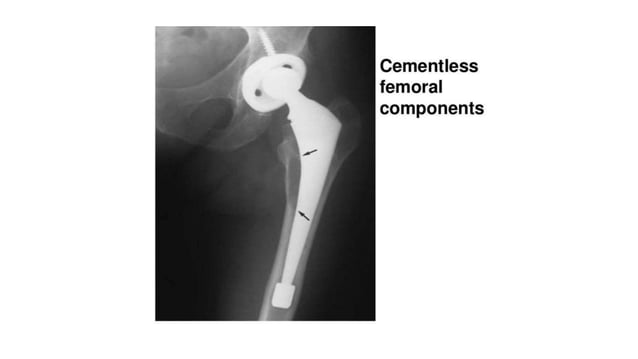 OSTEOLYSIS AND LOOSENING OF total hip arthroplasty IMPLANTS.pptx by dr ...