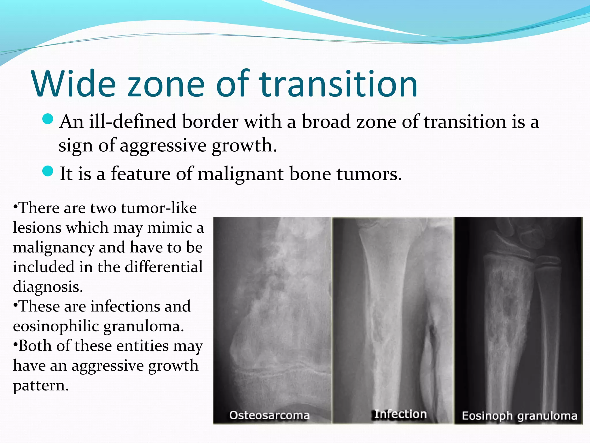 Osteolytic lesions of Bone | PPT