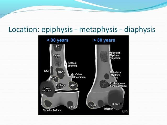 Osteolytic lesions of Bone | PPT | Bone and Joint Conditions | Diseases ...