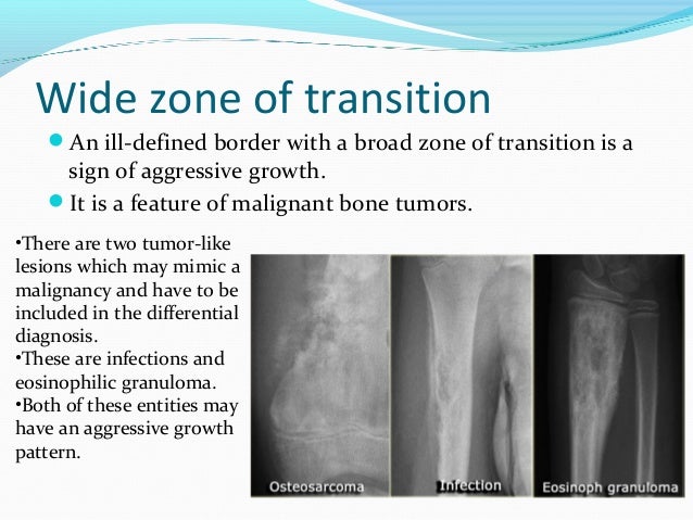 Osteolytic lesions of Bone