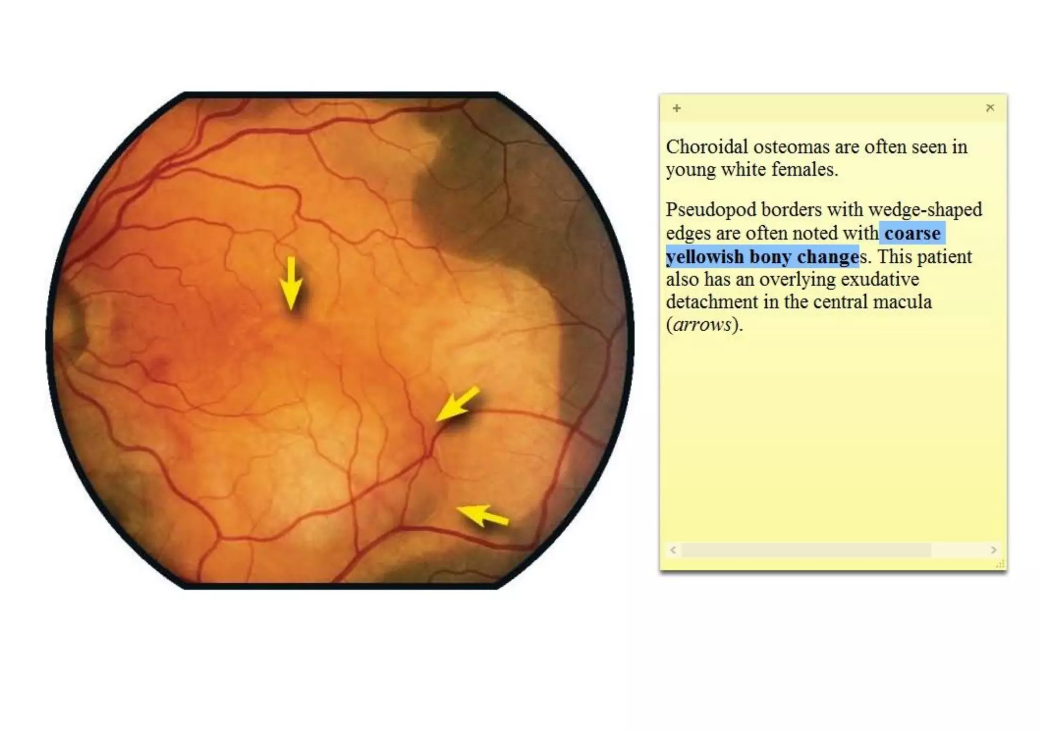 Choroidal Osteoma | PDF
