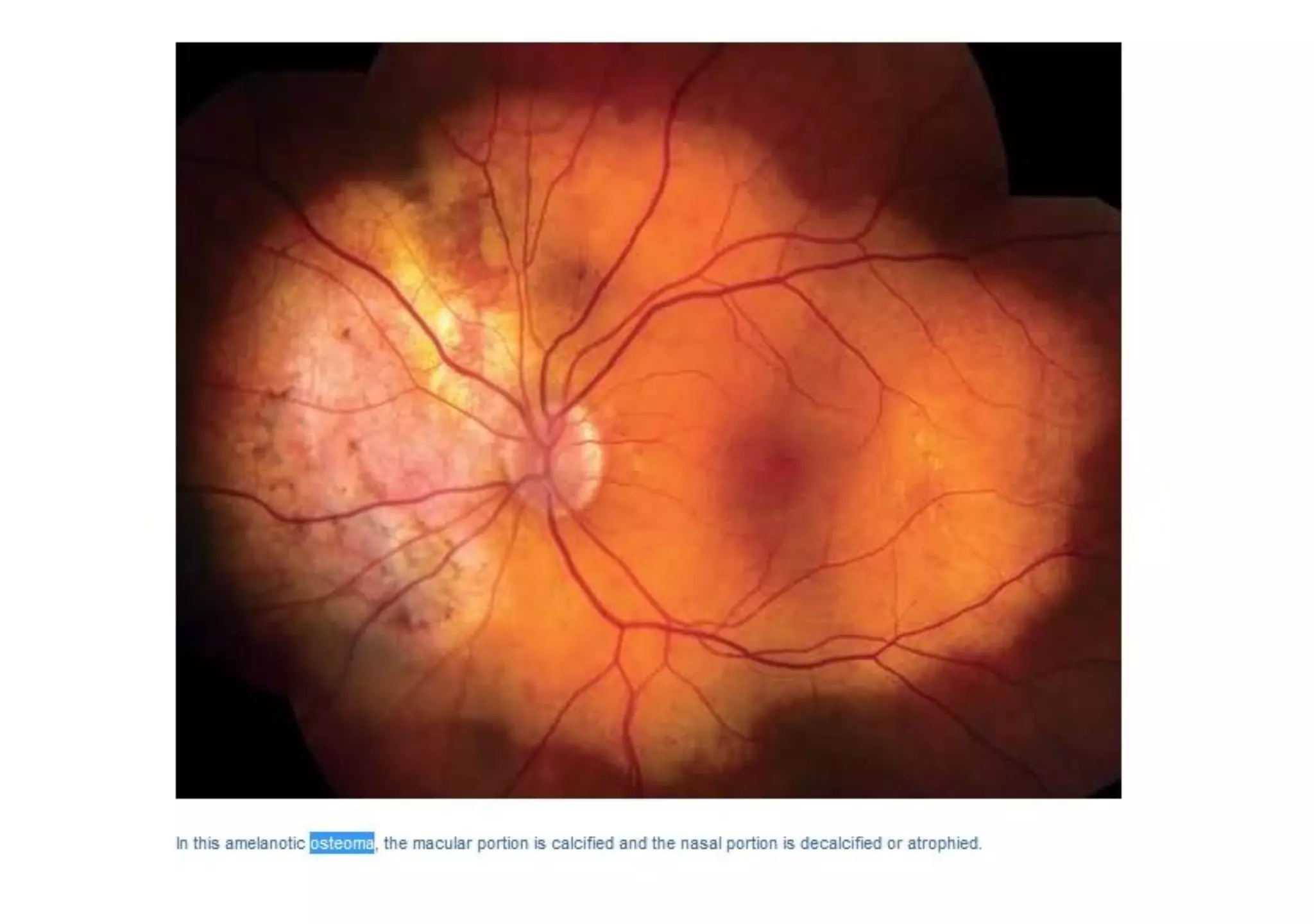 Choroidal Osteoma | PDF