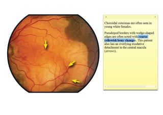 Choroidal Osteoma | PDF | Eye and Vision Conditions | Diseases and ...