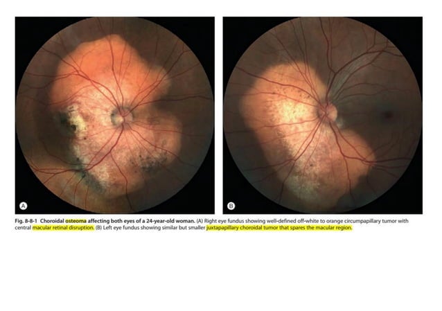 Choroidal Osteoma | PPT