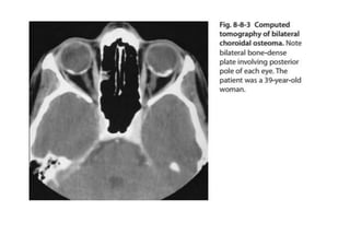 Choroidal Osteoma | PDF | Eye and Vision Conditions | Diseases and ...