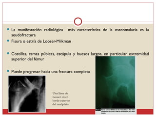 Osteomalacia medicina LOBOS | PPT