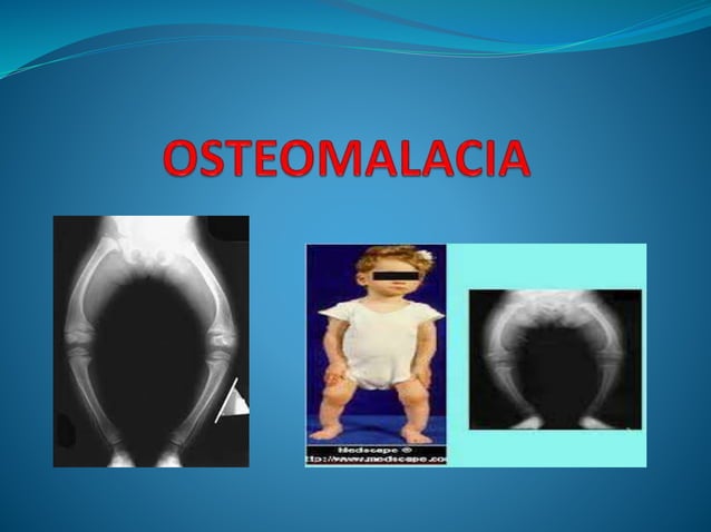 Osteomalacia Presentation | PPTX