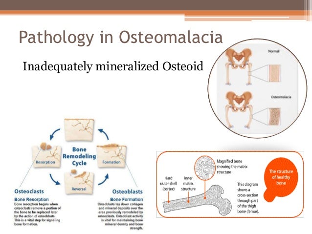 Osteomalacia