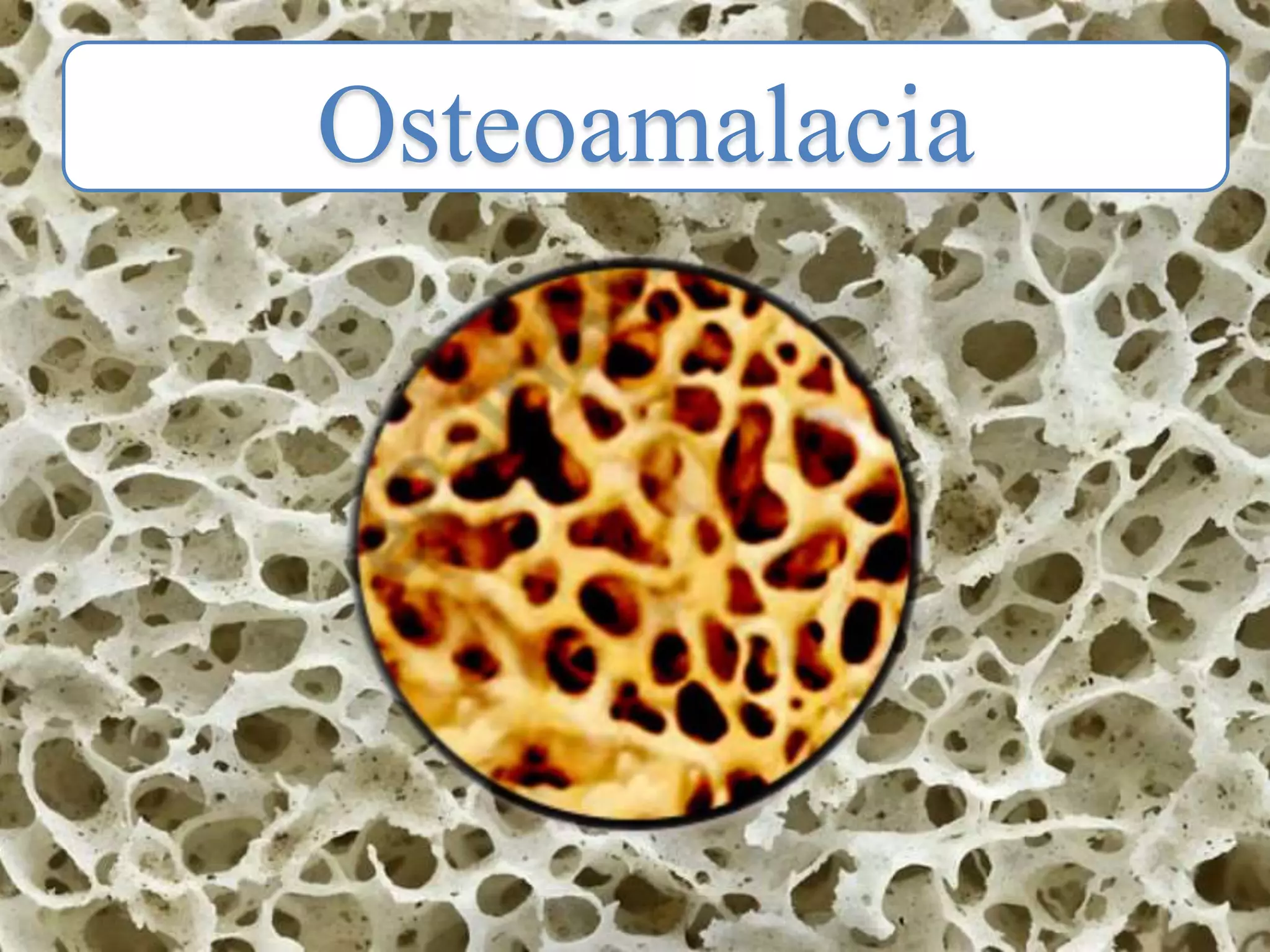 Osteomalacia | PPTX