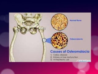 Osteomalacia Bone
