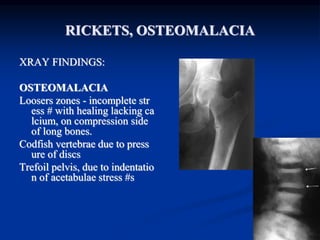 Osteomalacia.pptx