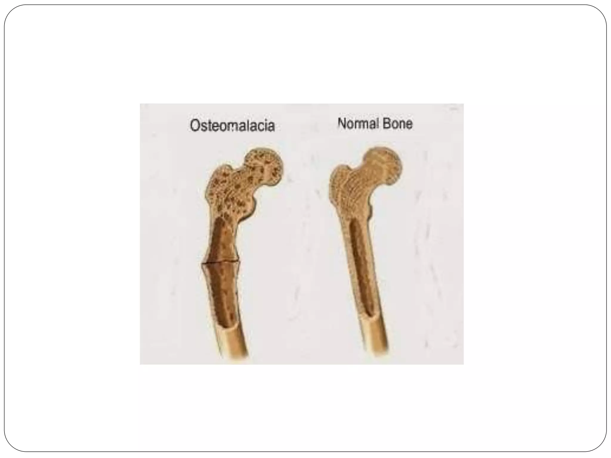 Osteomalacia | PPTX