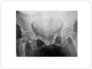 Triradiate Pelvis Osteomalacia