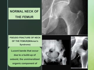 Osteomalacia 2nd-150704155942-lva1-app6892 [autosaved] | PPTX